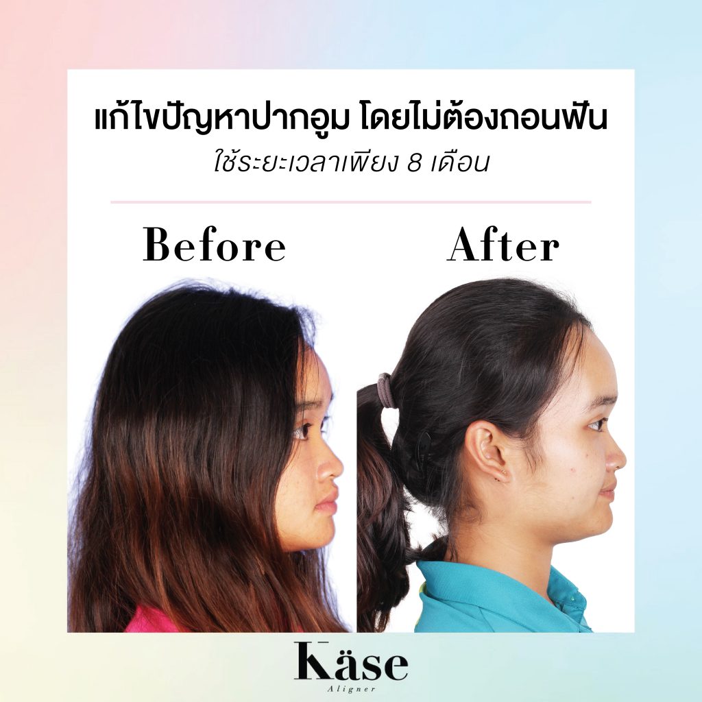 KÄSE Aligner - BFC Dental