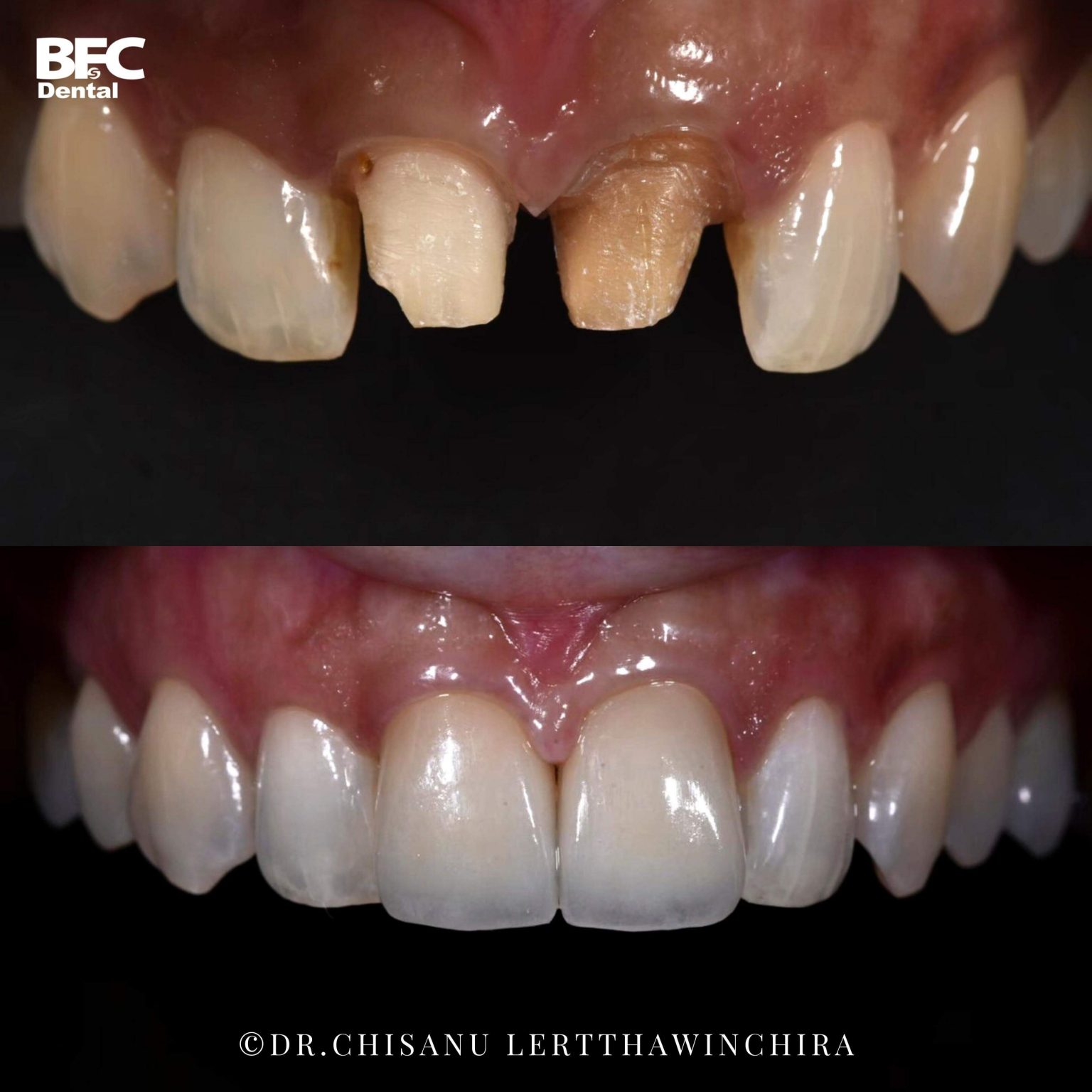 Hollywood Smile - BFC-Dental