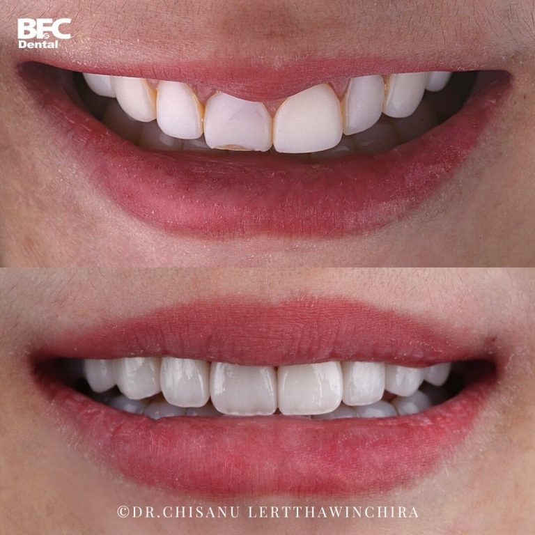 Hollywood Smile - BFC-Dental